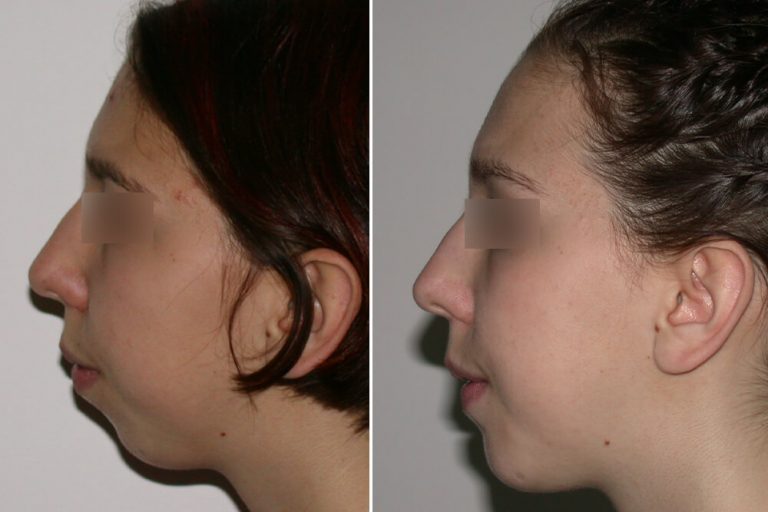 Korekcija brade – Operacijom do lepšeg izgleda || Beograd-Centar