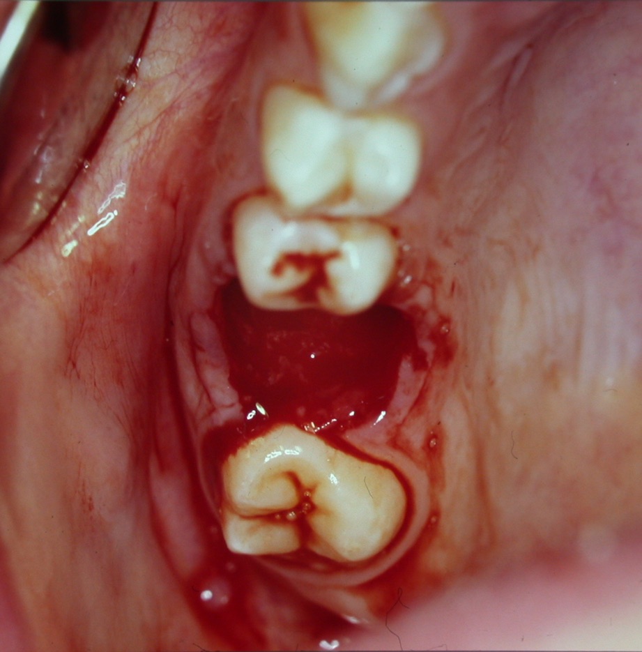 Transplantacija zuba || Ordinacija Beograd-Centar