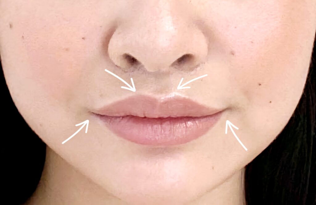 Šta je Lip lift? - Beograd Centar